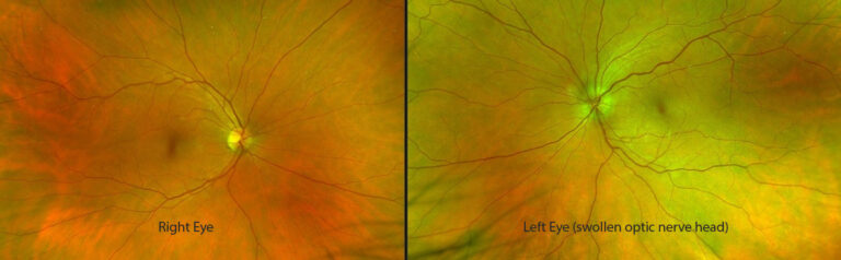 Optomap Retinal Imaging- Even a Healthy Image is Important