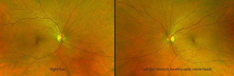 Optomap Retinal Imaging- Even a Healthy Image is Important